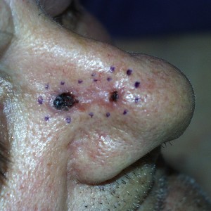 Basaliom - Praxisklinik Dr. Hasert Berlin - Hautarzt - Hautarzt Berlin ...