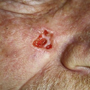 Basaliom - Praxisklinik Dr. Hasert Berlin - Hautarzt - Hautarzt Berlin ...