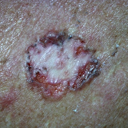 Basaliom - Praxisklinik Dr. Hasert Berlin - Hautarzt - Hautarzt Berlin ...