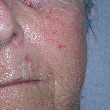 Basaliom - Praxisklinik Dr. Hasert Berlin - Hautarzt - Hautarzt Berlin ...