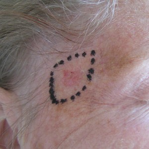 Basaliom - Praxisklinik Dr. Hasert Berlin - Hautarzt - Hautarzt Berlin ...